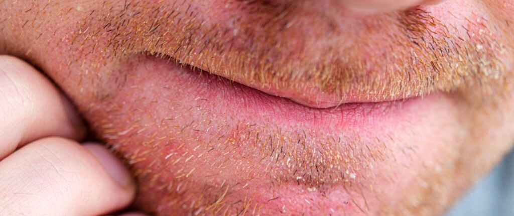 Clownseczeem wat is dit? Ook bekend als dermatitis perioralis