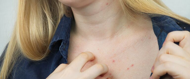 Hoe krijg je schurft en wat doe je ertegen?