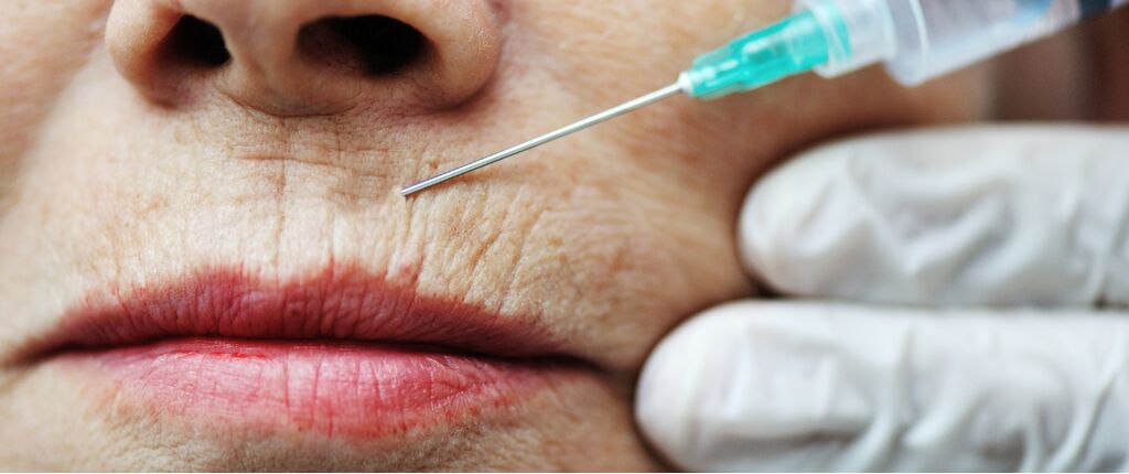 Rimpels rond je mond voorkomen doe je zó!