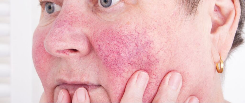 Rosacea: de symptomen, oorzaken en behandeling